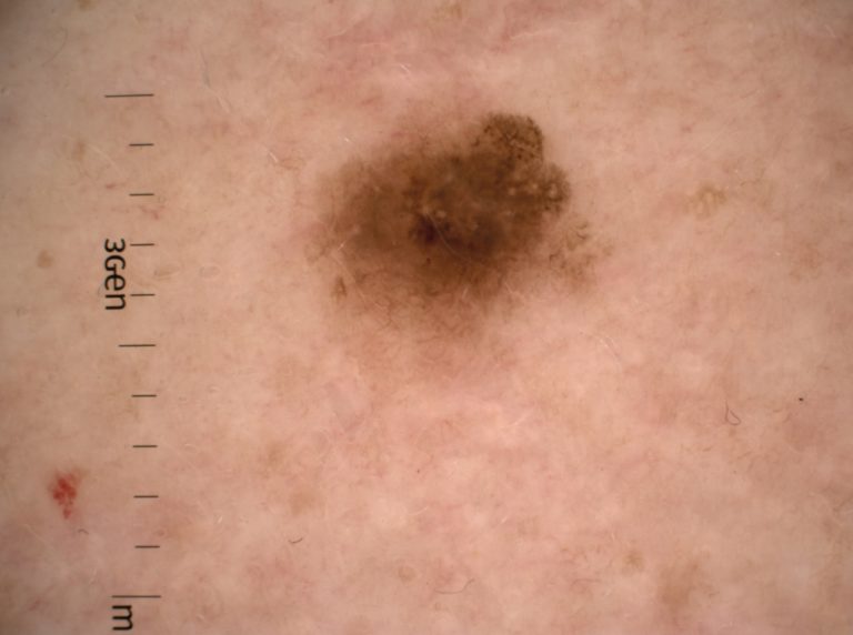 Kaiser Permanente Teledermatology Finds More Skin Cancers with Fewer ...