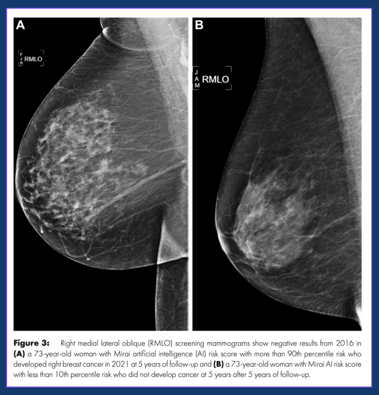 Mammography AI may have a role in breast cancer risk prediction ...
